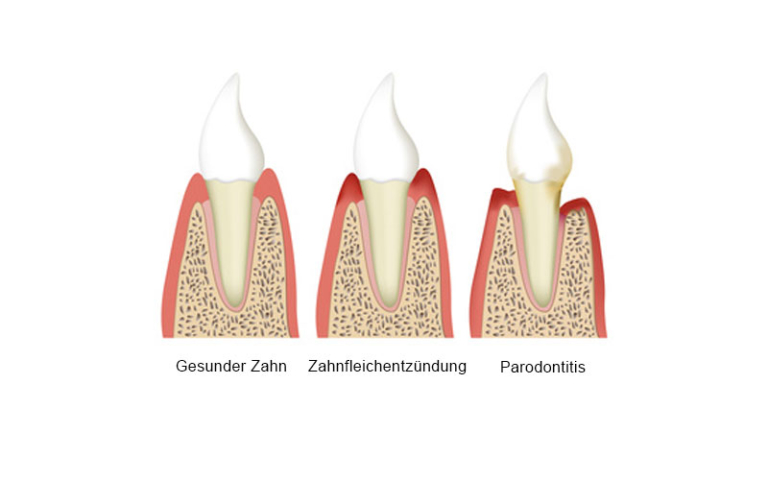 Parodontose – Zahnarzt Friedrichshafen